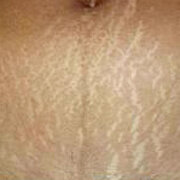 Estrias LASER - Tratamento de Estrias a LASER - Clínica Bergmann ...