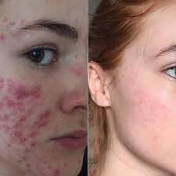 Tratamento a LASER de Acne Ativa - LASER Spectra XT Porto Alegre