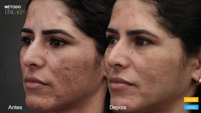 Line Skin - Peeling de Fenol com Máscara Clínica Bergmann