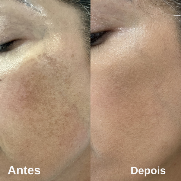 Line Skin - Peeling de Fenol com Máscara Clínica Bergmann
